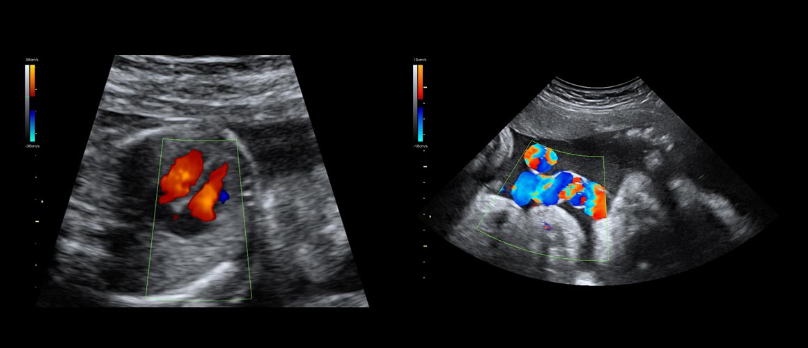 Morfologija – Ultrazvok v nosečnosti
